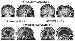 Docs get a brain-injured talking