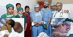 New lease of life for baby with two heads