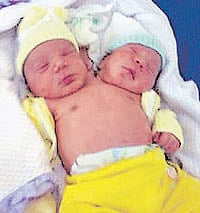 Baby born with two heads in Brazil