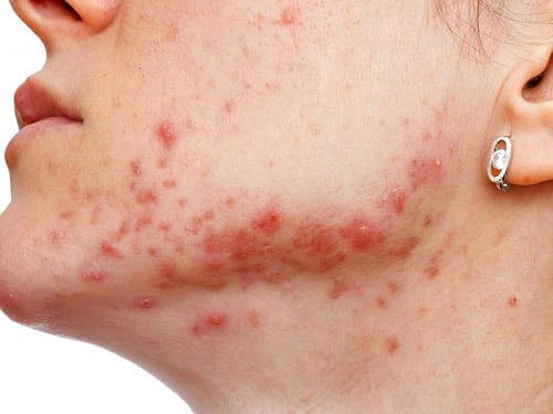Acne sufferers may age slowly: study