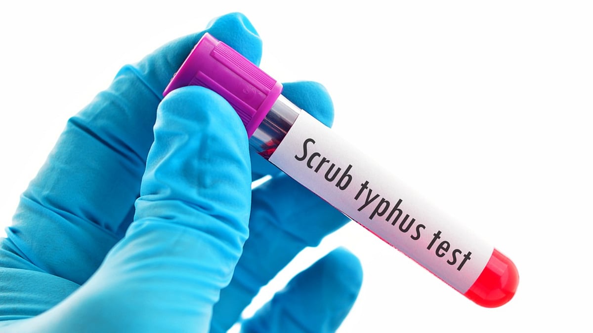 Explained | All you need to know about scrub typhus, the disease adding ...