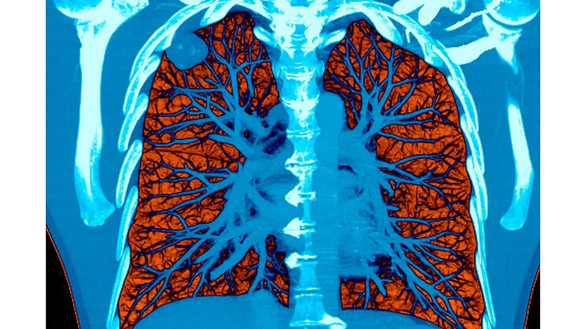 10 Common diseases caused by air pollution - In Pics